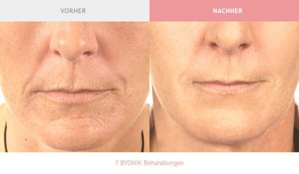 Falten, Schlupflider und Narben behandeln mit dem Fraktional Laser