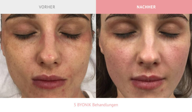 Falten, Schlupflider und Narben behandeln mit dem Fraktional Laser