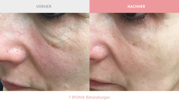 Falten, Schlupflider und Narben behandeln mit dem Fraktional Laser