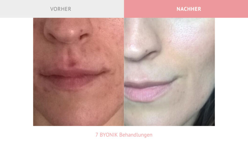 Falten, Schlupflider und Narben behandeln mit dem Fraktional Laser